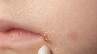 Krentenbaard: zo herken en behandel je het | Albert Heijn